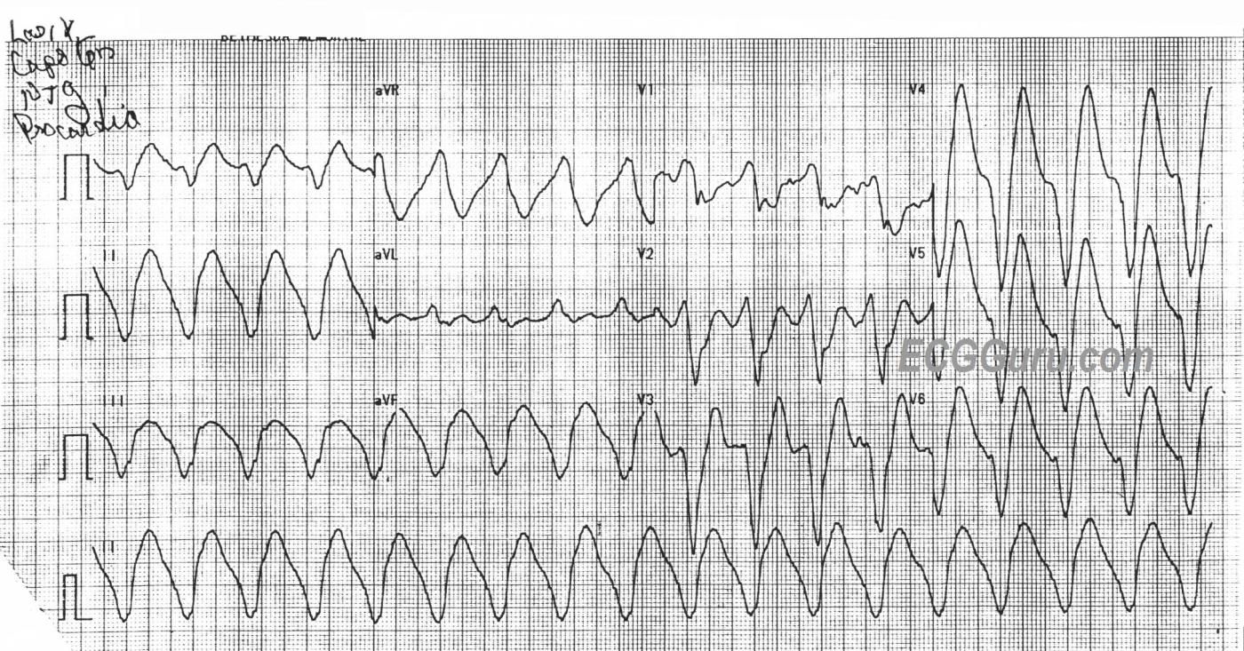 Regular Really Wide QRS Tachycardia | ECG Guru - Instructor Resources